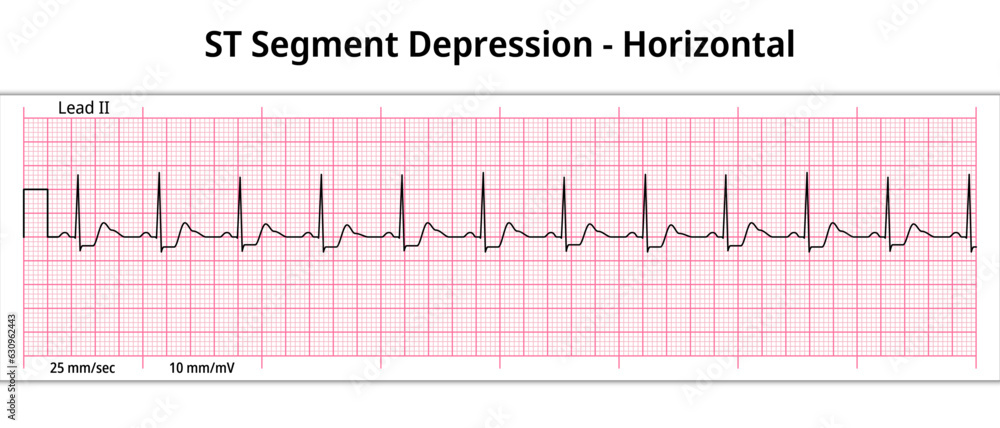 ECG ST Segment Depression - Horizontal - 8 Second ECG Paper ...