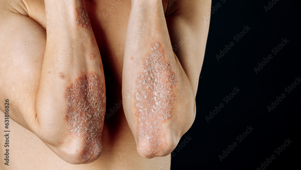 Acute psoriasis on the elbows is an autoimmune incurable dermatological ...