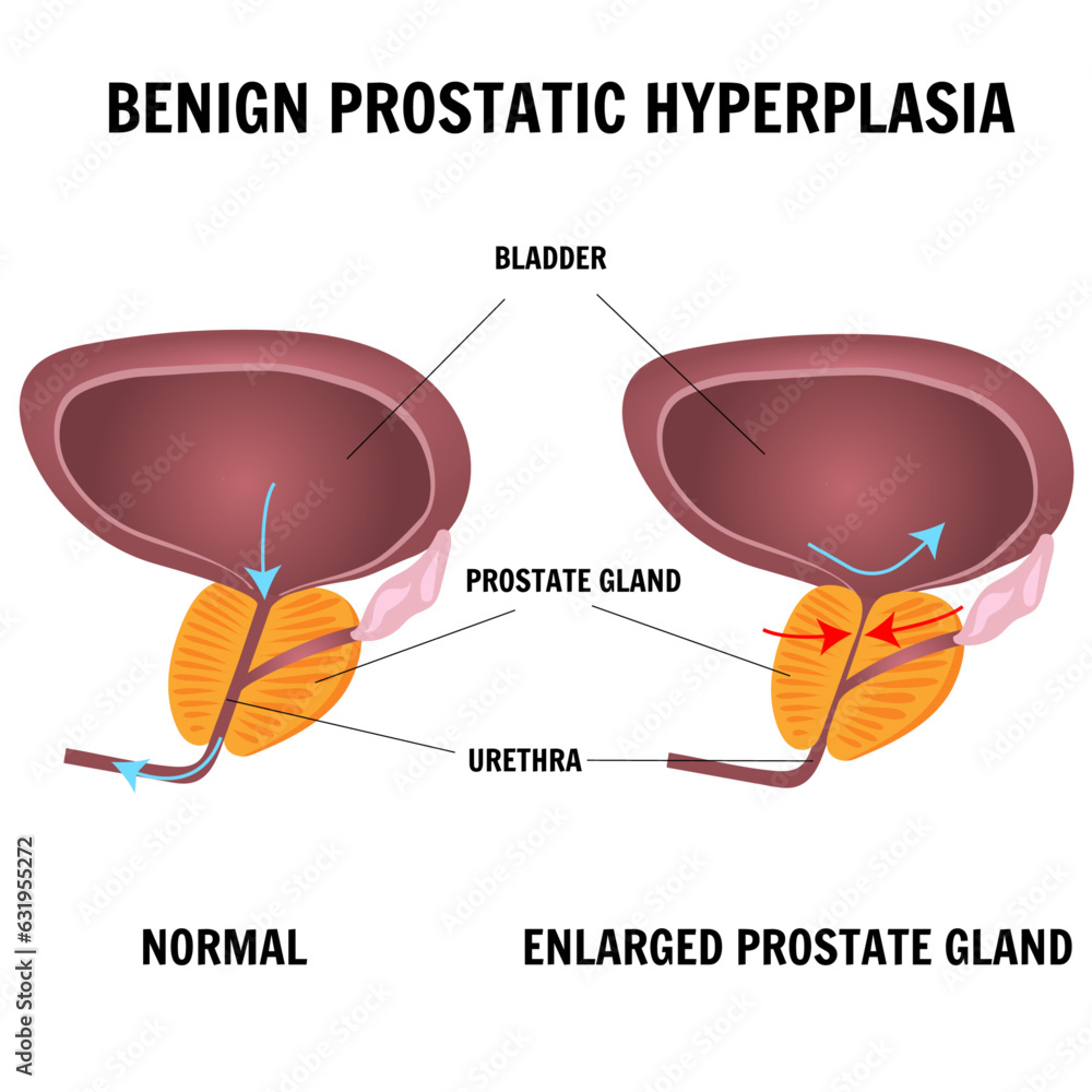 Medical infographic normal prostate and benign prostatic hyperplasia in ...