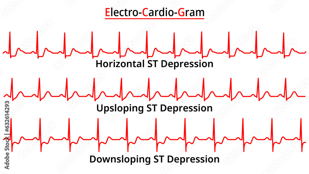 Set of ECG Common Abnormalities - ST Segment Depression - Upsloping ...