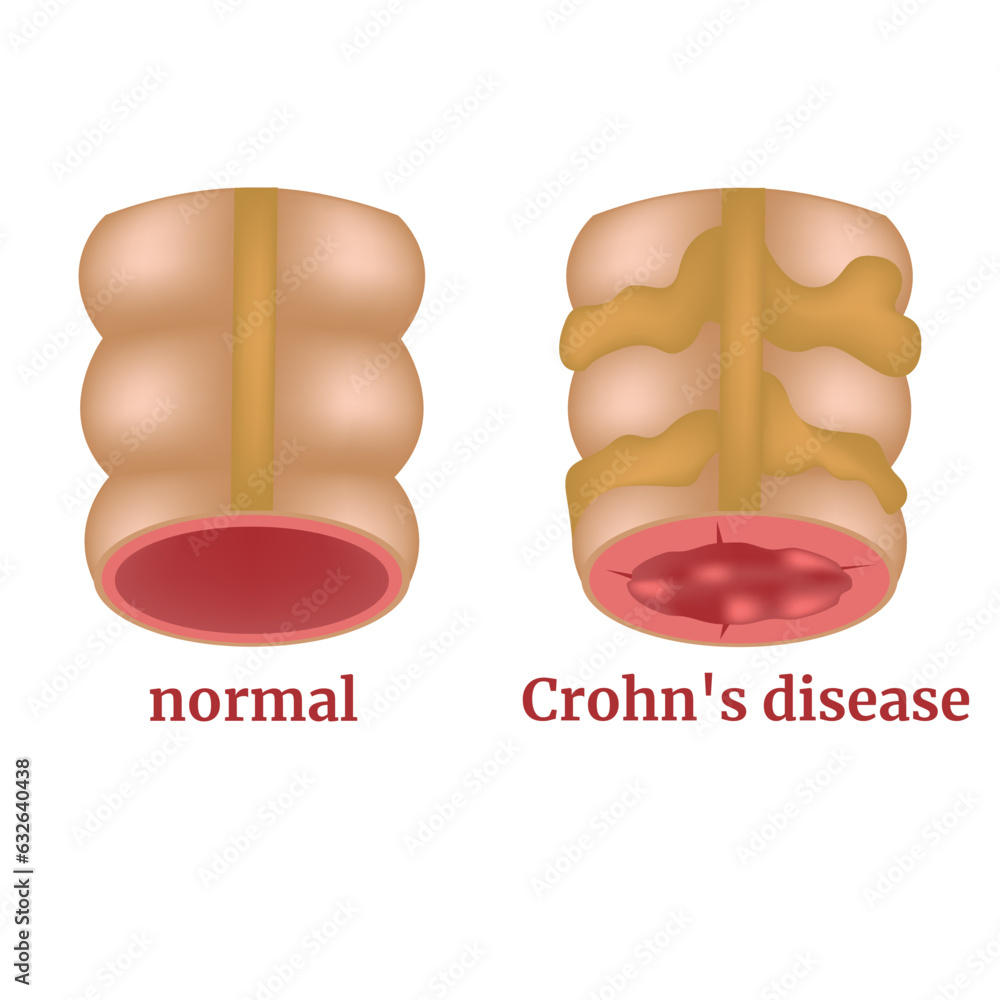 Vector de Stock Crohn's disease. Chronic inflammation of the digestive ...
