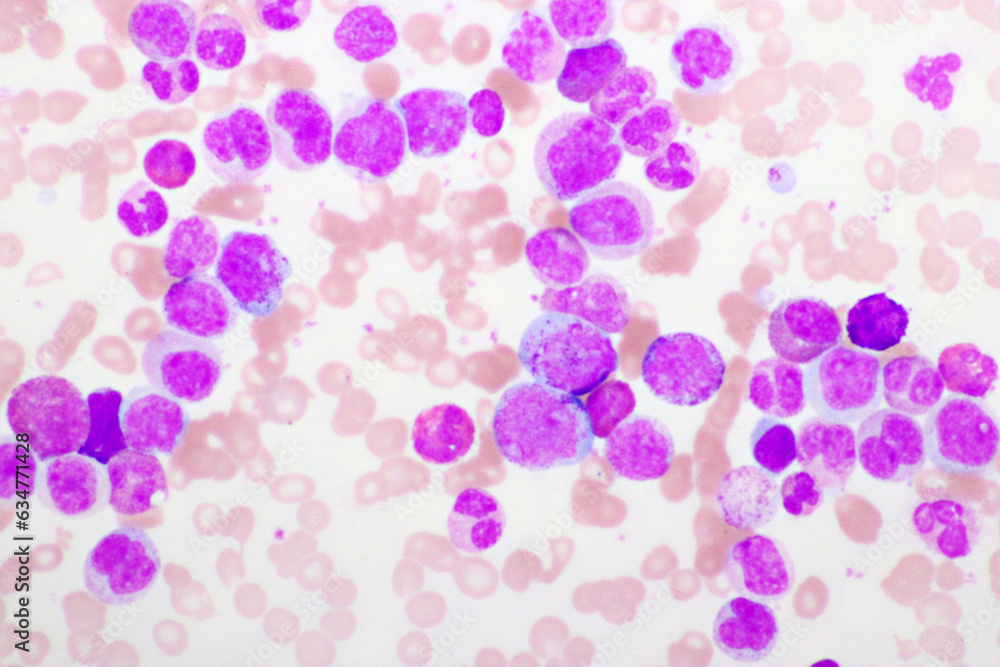 Chronic myeloid leukemia cells or CML, analyze by microscope Stock ...