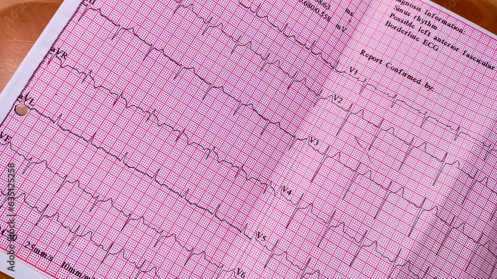 ekg ecg pulse rate red grid paper that shows sinus rhythm abnormality ...