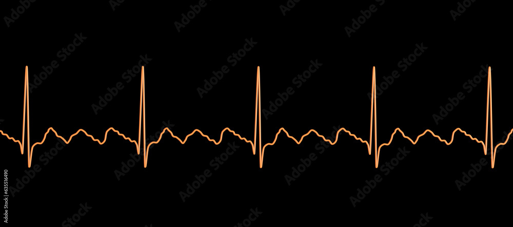 ECG in atrial flutter, 3D illustration Stock Illustration | Adobe Stock