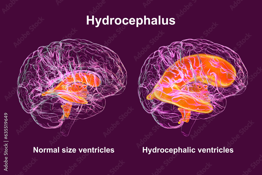 Enlarged ventricles of the child brain and normal ventricular system ...