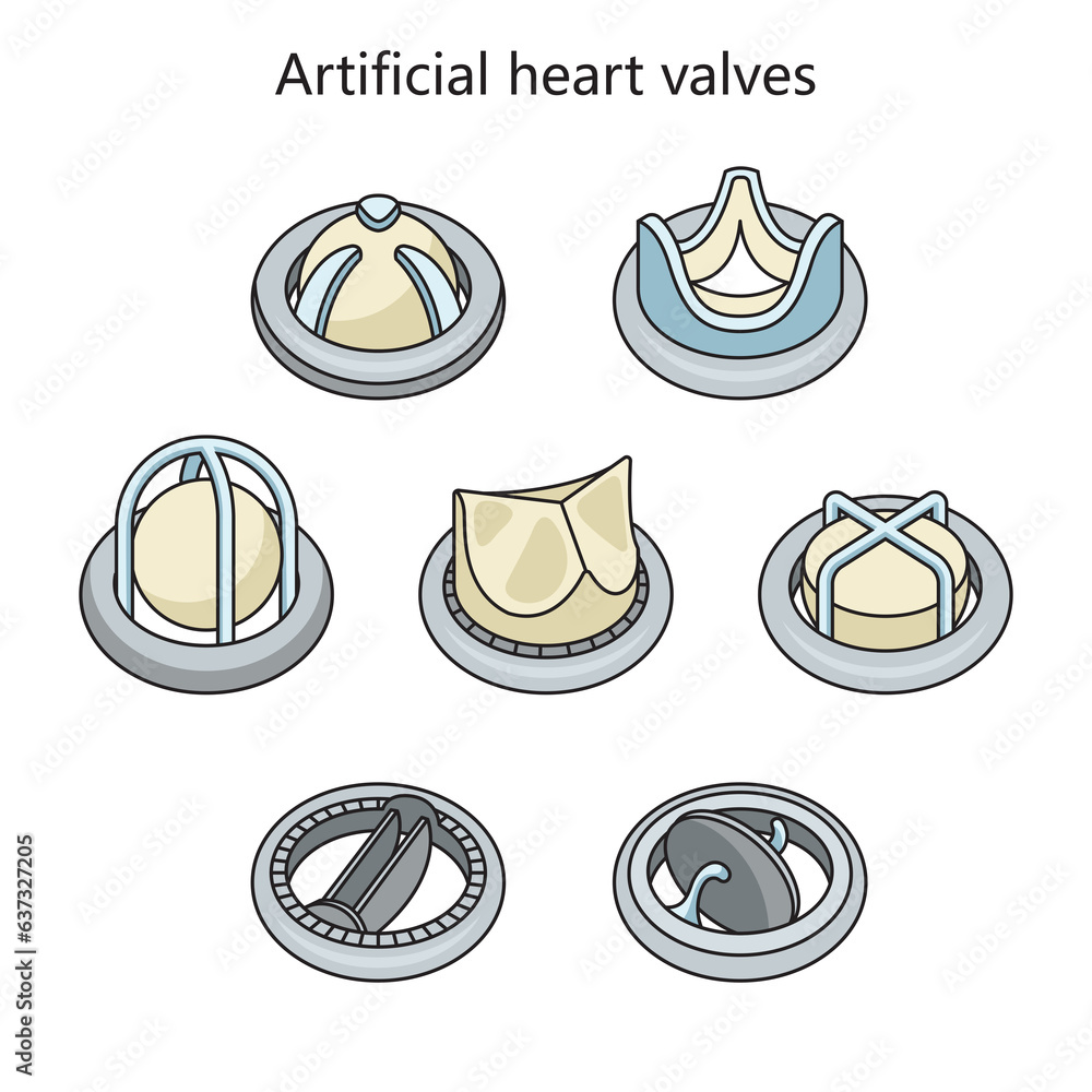 Artificial heart valve implant in human heart diagram schematic raster ... Artificial heart valve implant in human heart diagram schematic raster ...