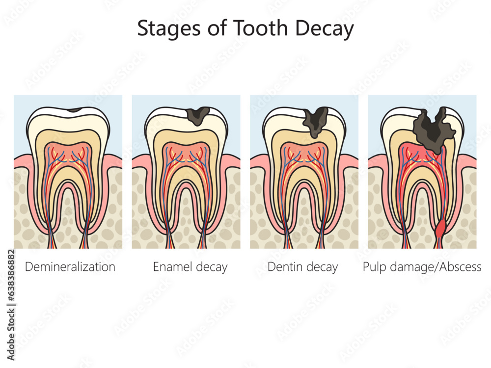 Tooth decay caries stages diagram schematic vector illustration ...