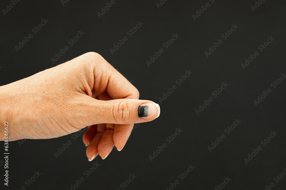 Subungual hematoma present under the toenail of the hallux, more ...