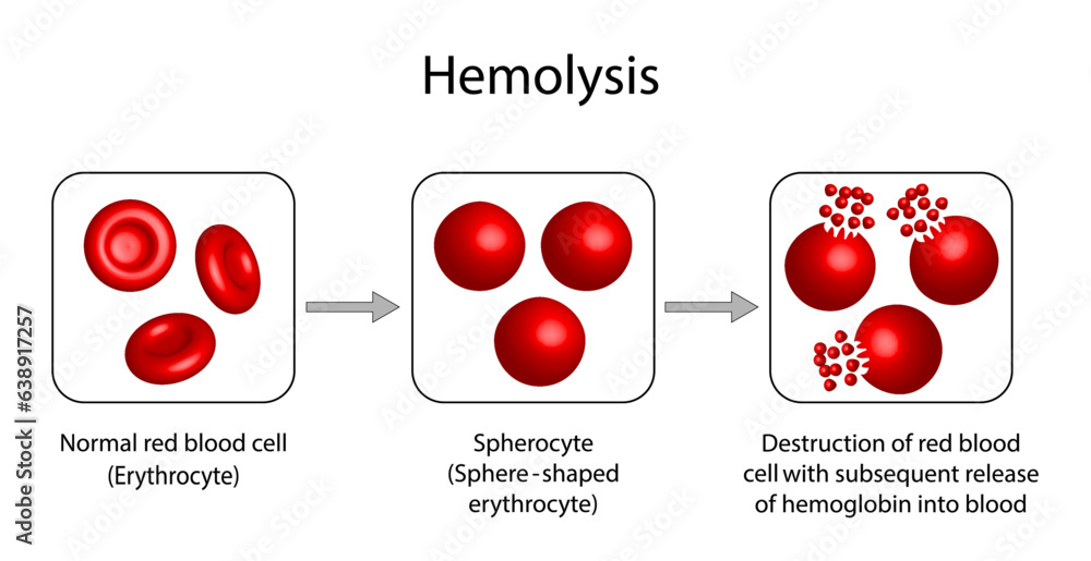 เวกเตอร์ Stock Hemolysis. Normal red blood cell, spherocyte, then ...