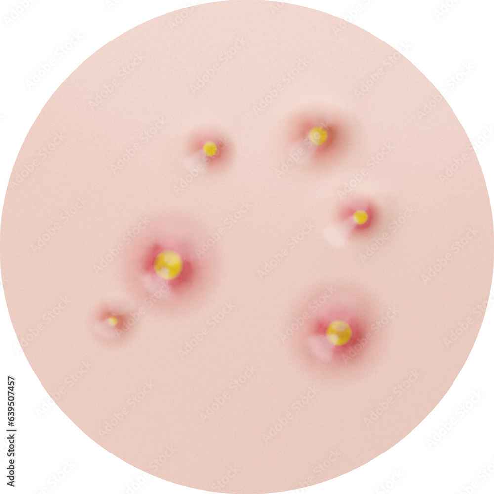 Acne papules and pustules type 3D rendering. Stock Illustration | Adobe ...