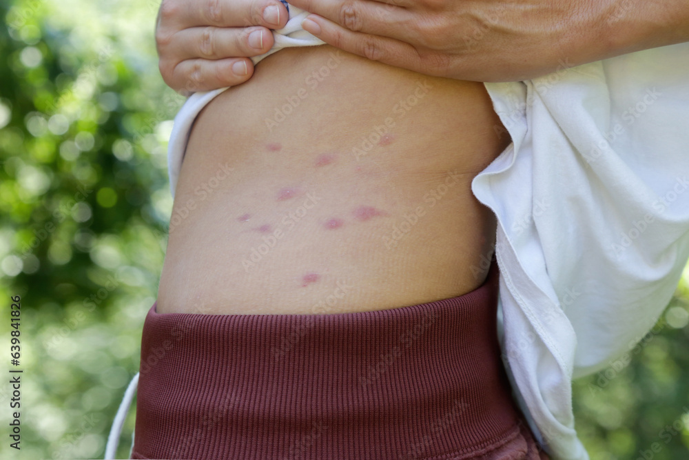 Red, swollen and itchy spots on skin caused by insect bites or allergy ...