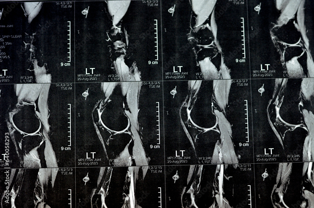 MRI of left knee joint showing minimal joint effusion, PHMM Posterior ...