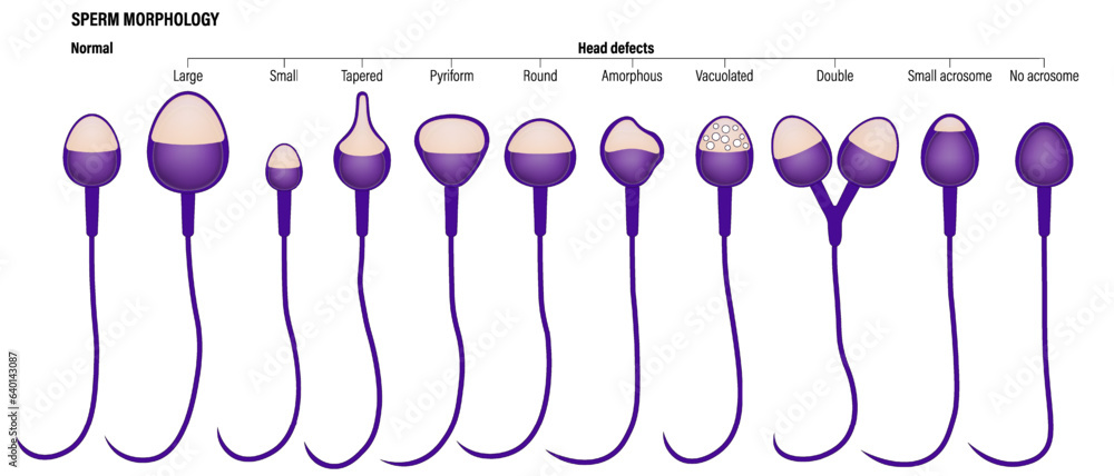 Normal and head defects spermatozoon. Semen analysis vector. Sperm ...