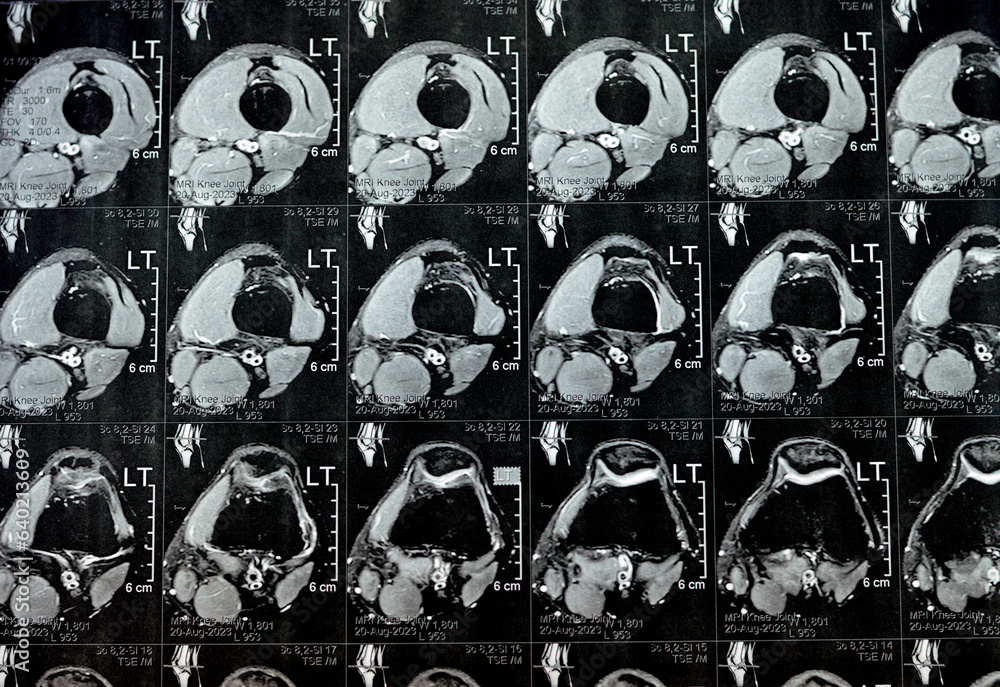 MRI of left knee joint showing minimal joint effusion, PHMM Posterior ...