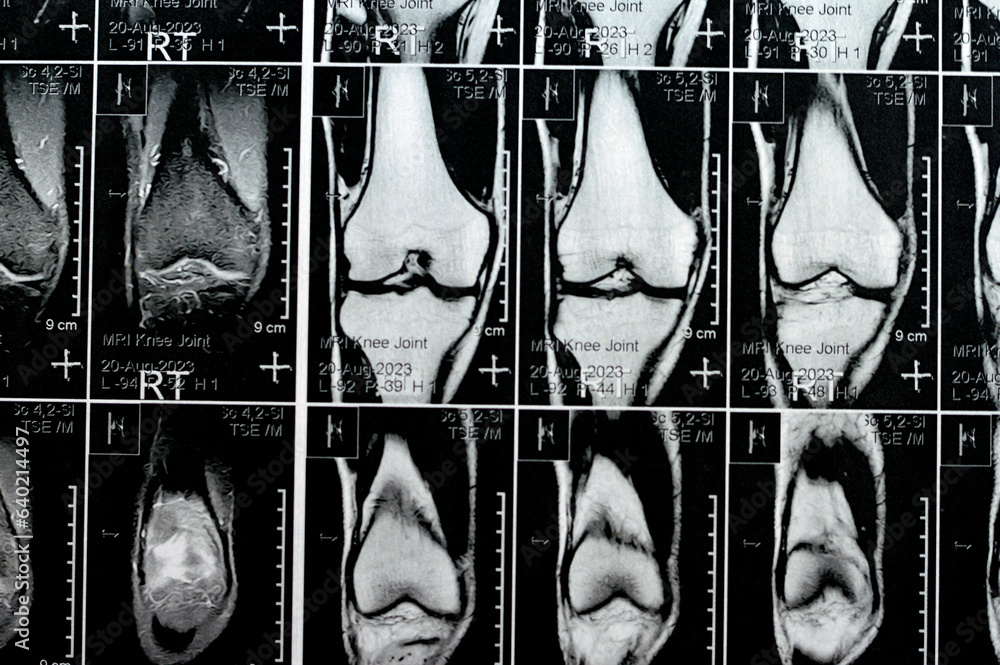 MRI of the right knee showing mild joint effusion, with normal other ...