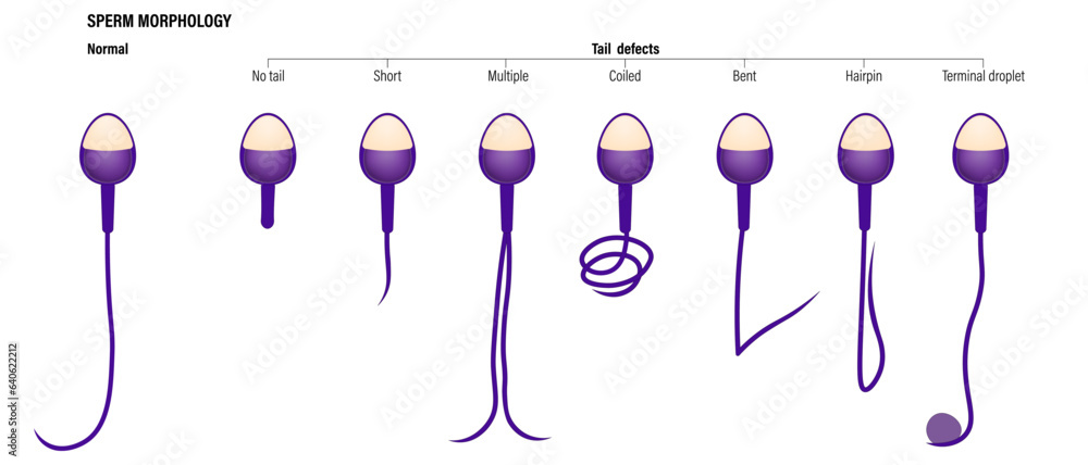 Normal and Tail defects spermatozoon. Semen analysis vector. Sperm ...
