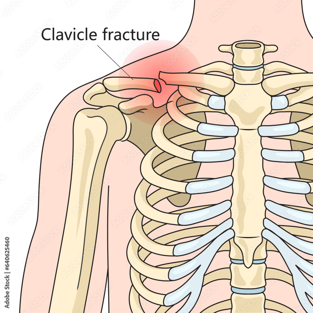 Vector de Stock Clavicle fracture broken collarbone structure diagram ...