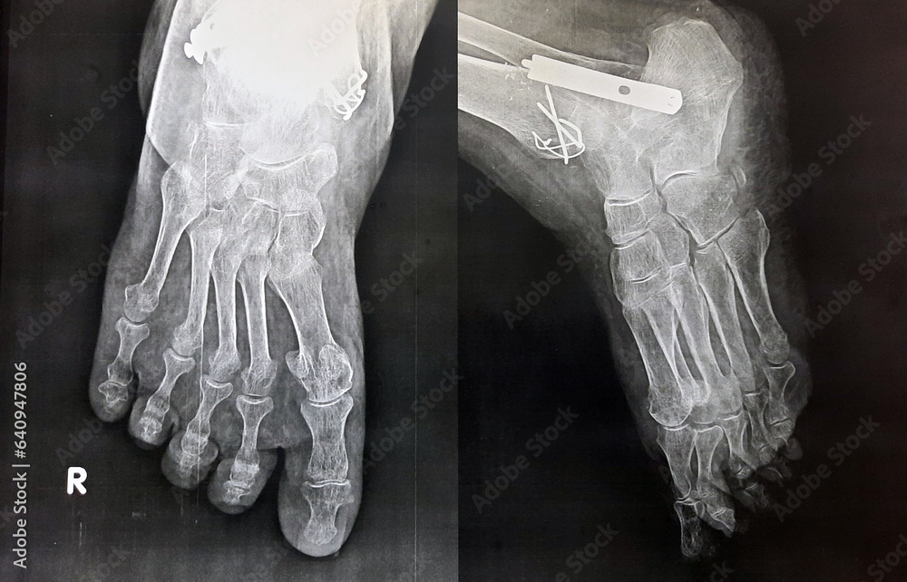 Plain x ray of the right foot of an old female patient with a new ...