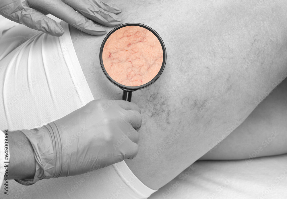 doctor shows the dilation of small blood vessels of the skin on the leg ...