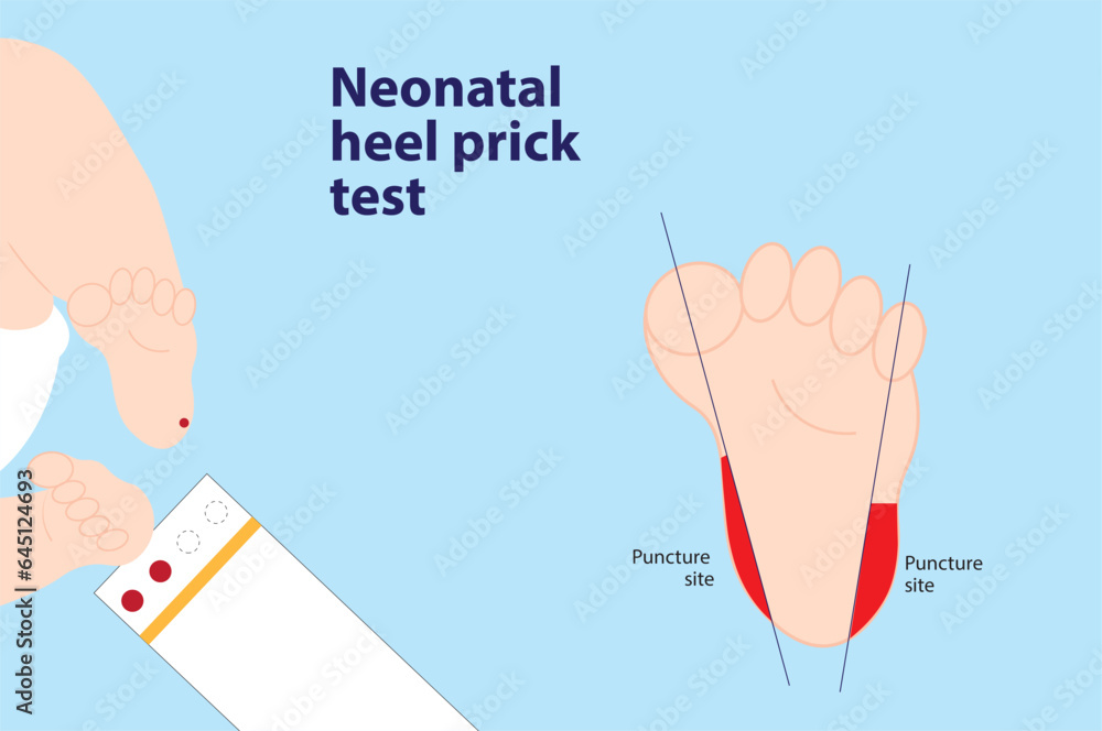 Vector de Stock Neonatal heel prick test illustration. Newborn foot ...