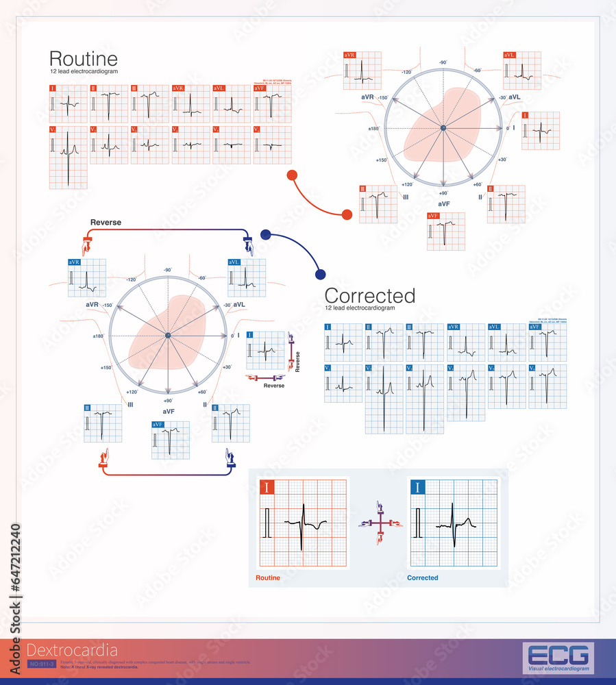Illustration Stock Female, 5-year-old, clinically diagnosed with ...