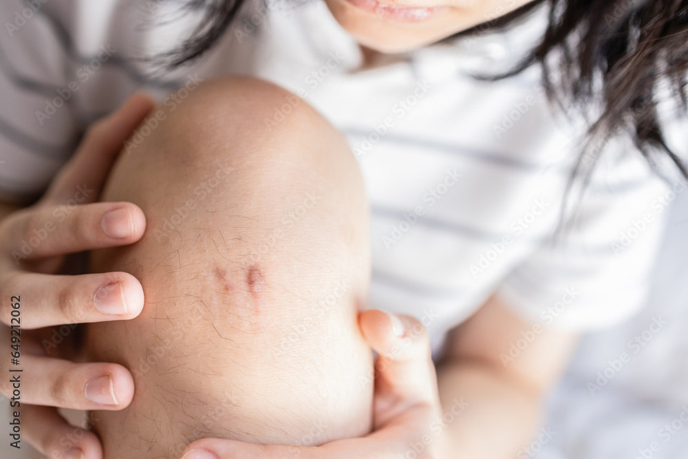 Stressed teenager girl with Hypertrophic scar,experiencing scar problem ...