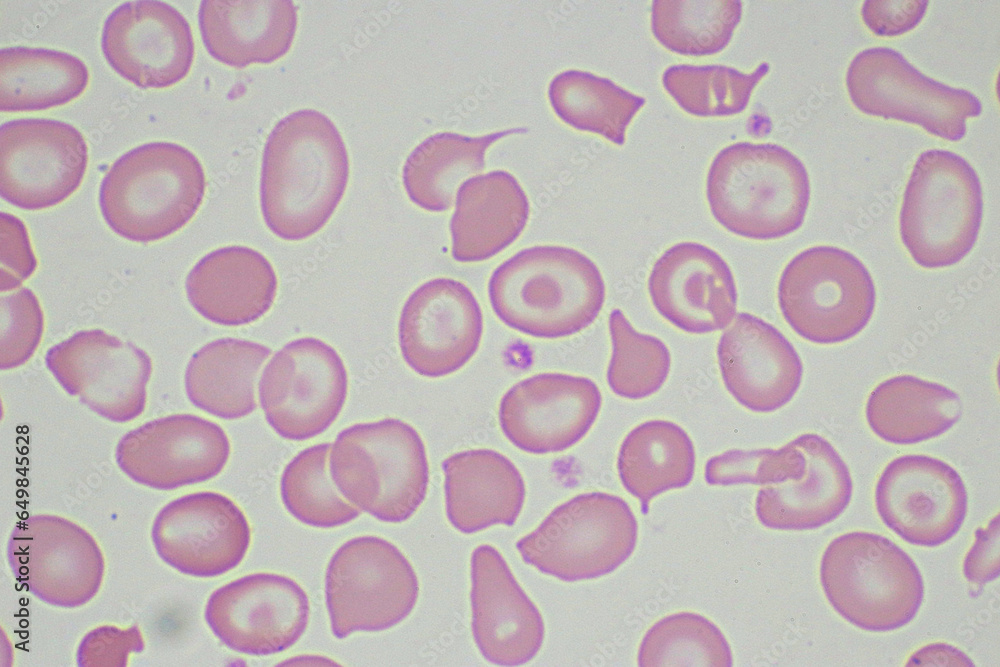 Abnormal red blood cells from thalassemia patient Stock Photo | Adobe Stock