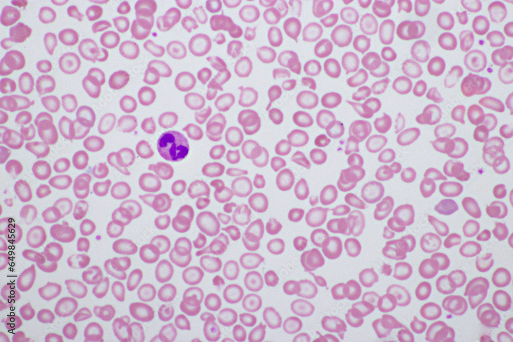 Abnormal red blood cells from thalassemia patient Stock Photo | Adobe Stock