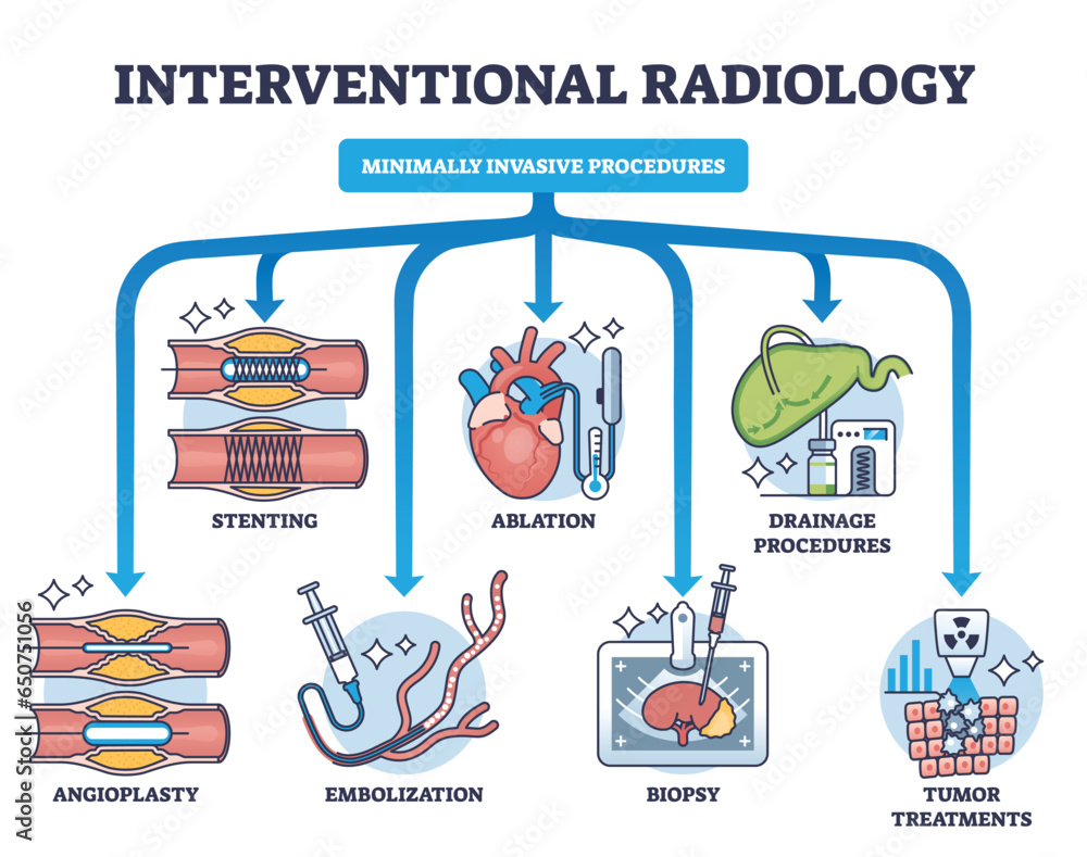 Interventional radiology as minimally invasive procedures outline diagram. Labeled educational ...