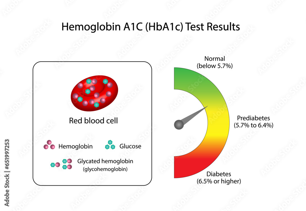 Hemoglobin A1C, HbA1c test , HbA1c levels, Glucose sticks to hemoglobin ...