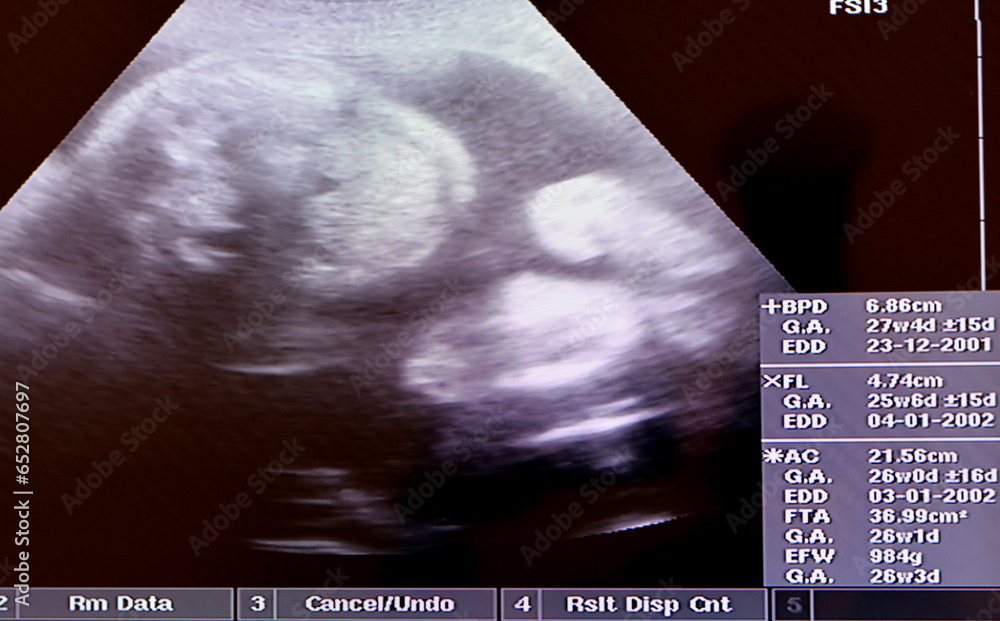 Ultrasonography on the uterus of a pregnant woman showing a healthy ...