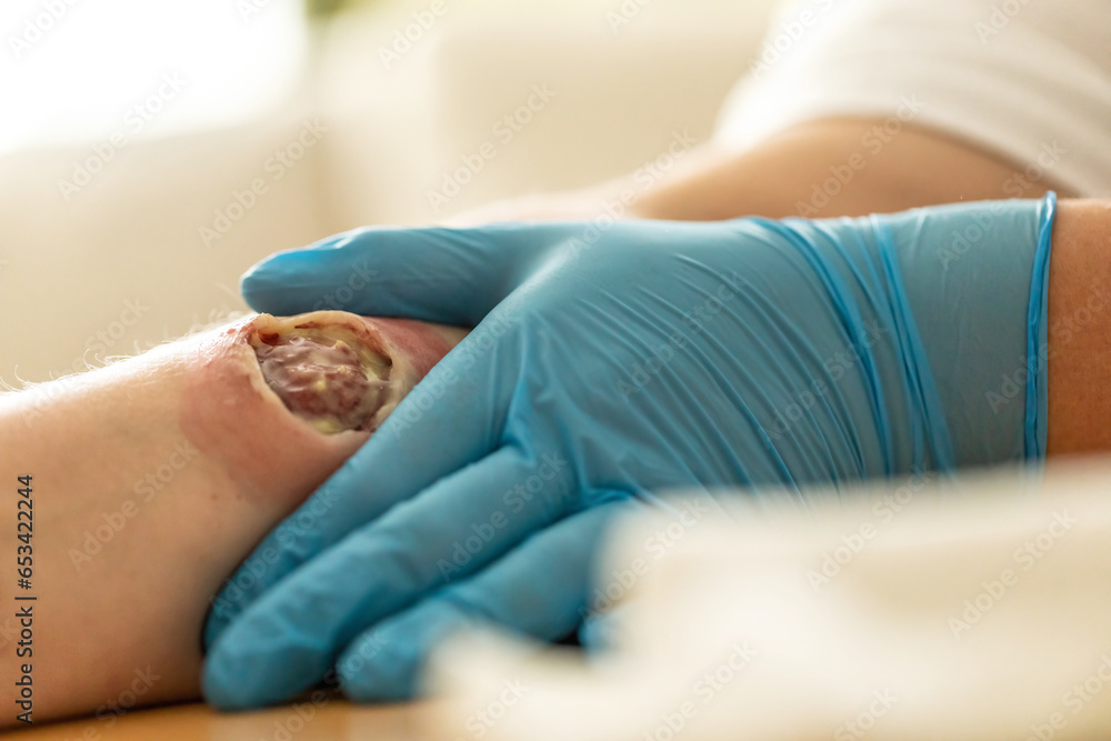 Wound care concept: Symbolizing change of dressing and cleaning and ...