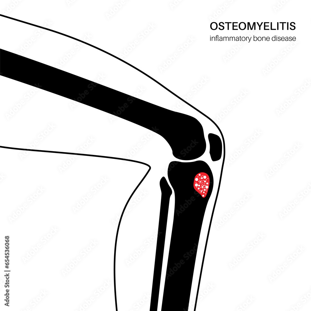 Tibia bone osteomyelitis Stock Vector | Adobe Stock