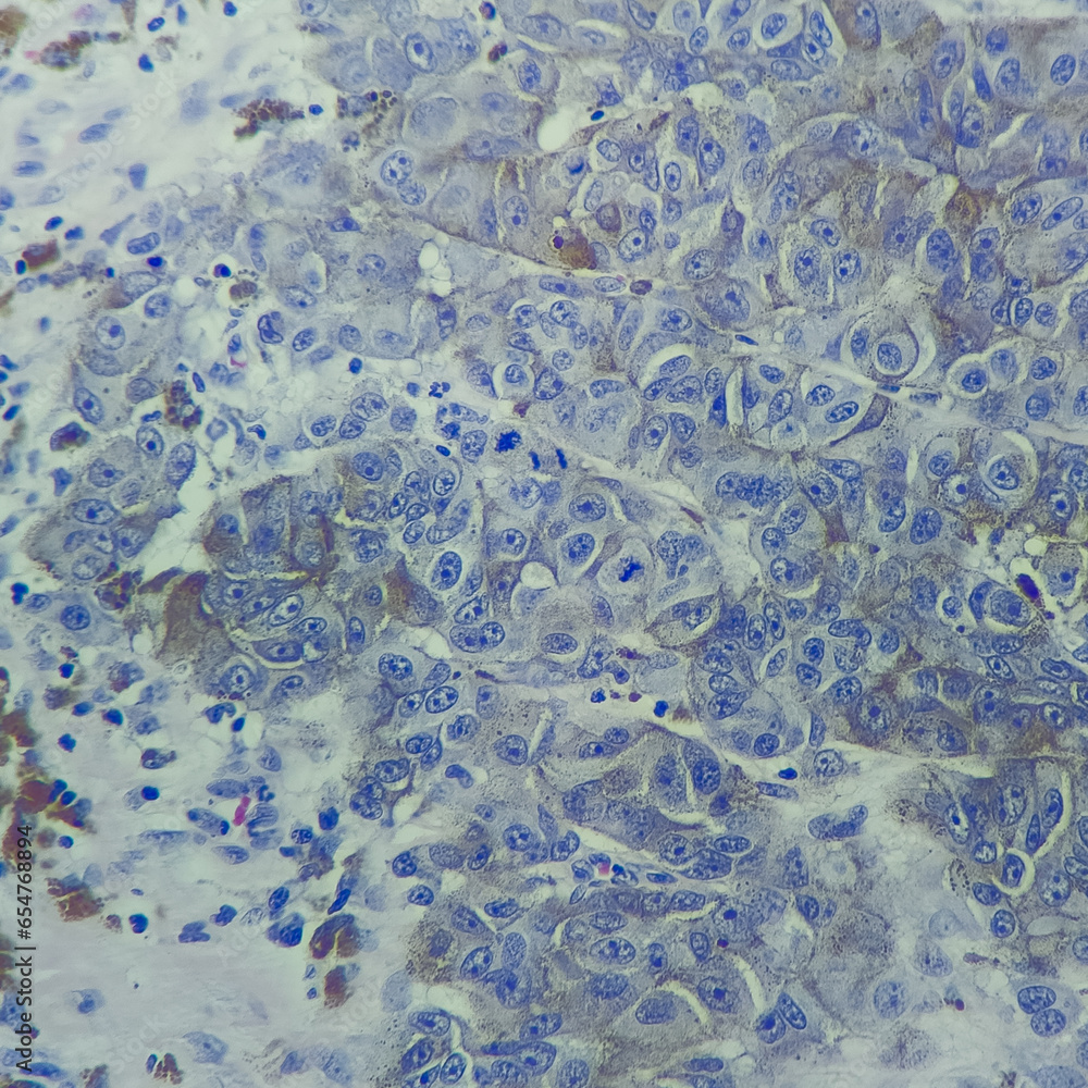 Camera photo of malignant melanoma, showing neoplastic cells with brown ...