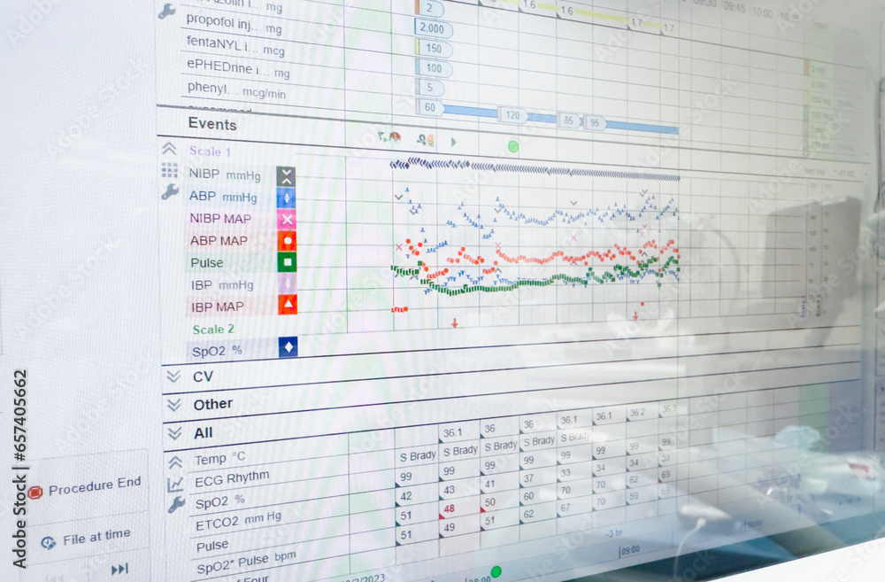 Medical monitor displays vital signs with graphs and numbers, heart ...
