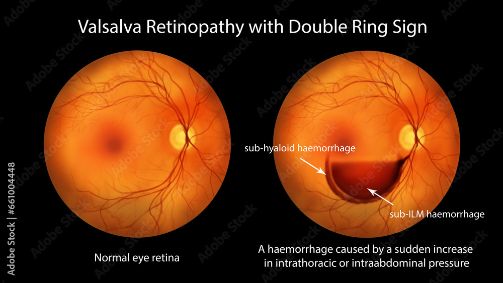 Valsava retinopathy, a preretinal hemorrhage caused by a sudden ...