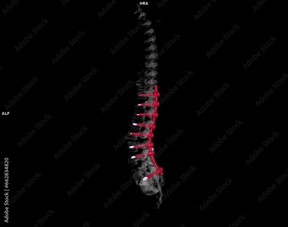 CT scan of thoracic and lumbar spine 3d rendering showing pedicle screw ...