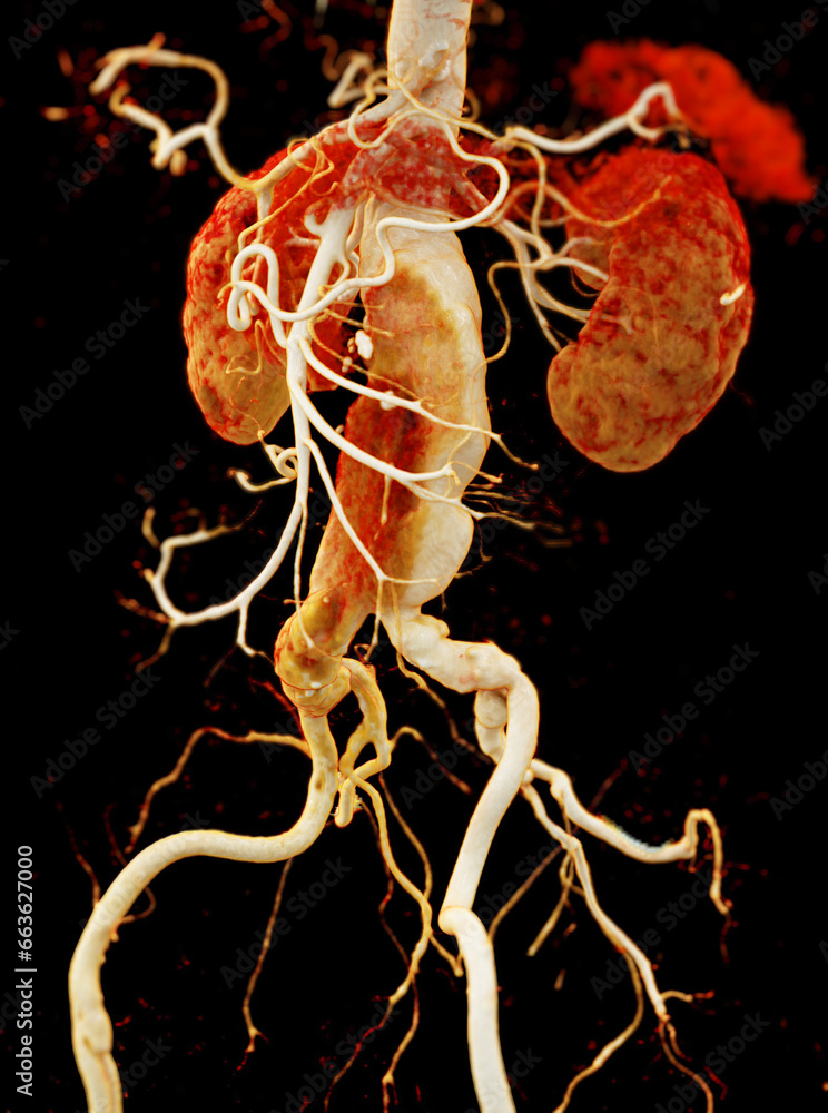 CTA abdominal aorta showing abdomenal aortic dissection 3D rendering ...