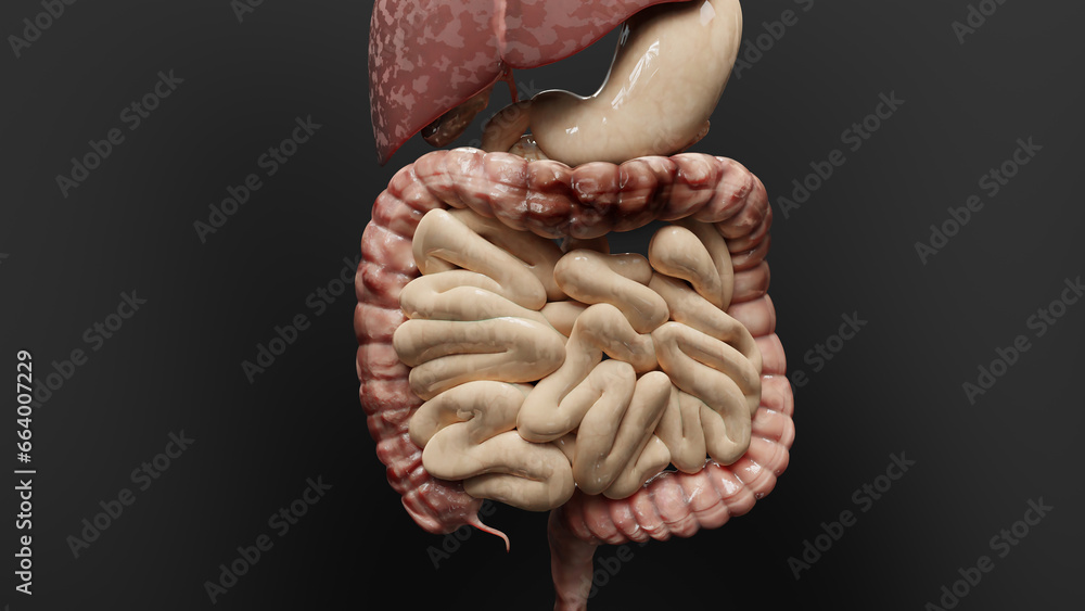 Colorectal cancer, malignant tumor in intestine, Endoscope inside ...