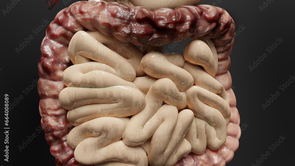 Ilustración de Stock Colorectal cancer, malignant tumor in intestine ...