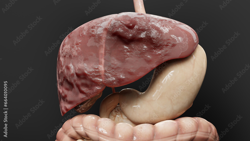 Ilustración de Stock Digestive Organ Liver Cancer, Hepatitis cirrhosis ...