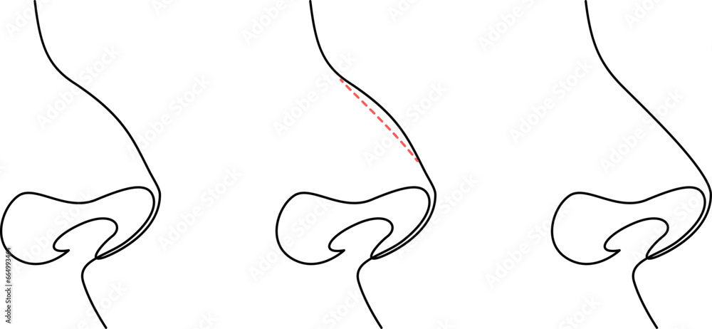 Plastic surgery performed on the nose continuous one line drawing ...