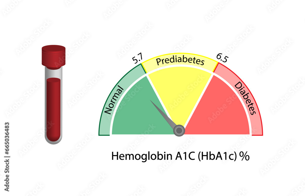 Vetor Hemoglobin A1C, HbA1c test results, glycated hemoglobin, A1C ...