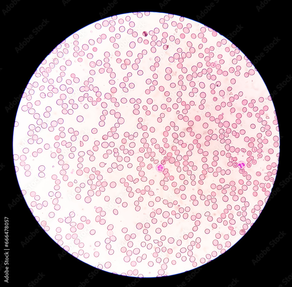 Photomicrograph: Suggestive of megaloblastic anemia to rule out ...