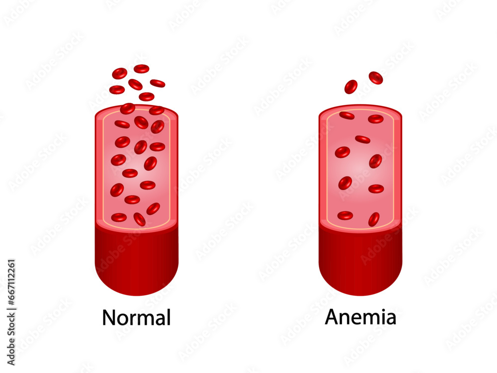 Iron deficiency anemia. The difference of Anemia amount of red blood ...