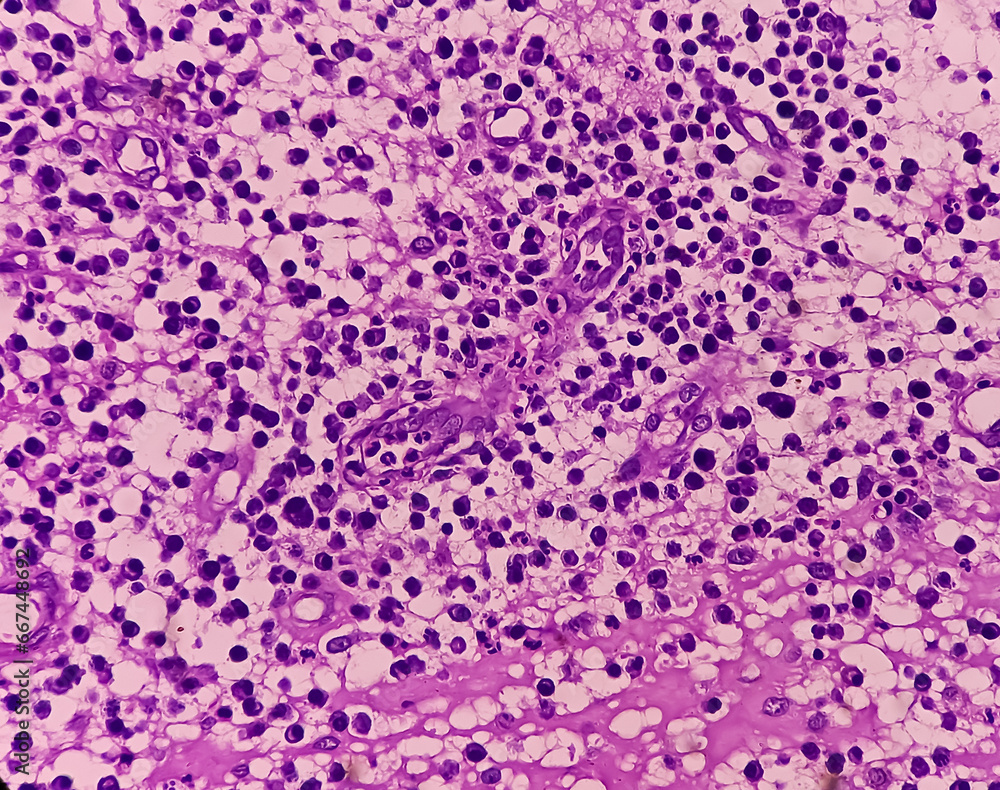 Ear Biopsy Microphotograph Of Granulation Tissues Show Dense Infiltration Of Polymorphs