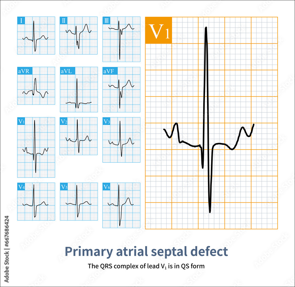 Illustration Stock A 7-year-old male patient with a primary foramen ...