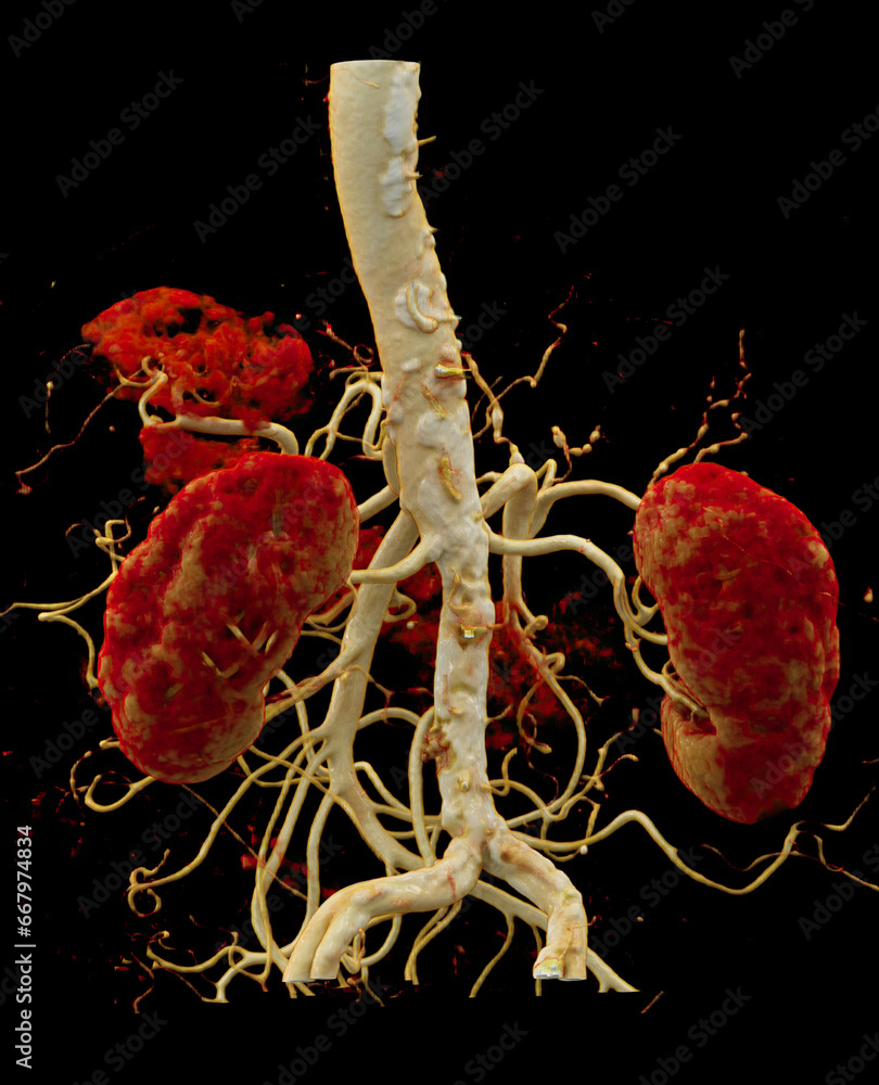 CTA Renal artery is a medical imaging procedure using CT scans to ...
