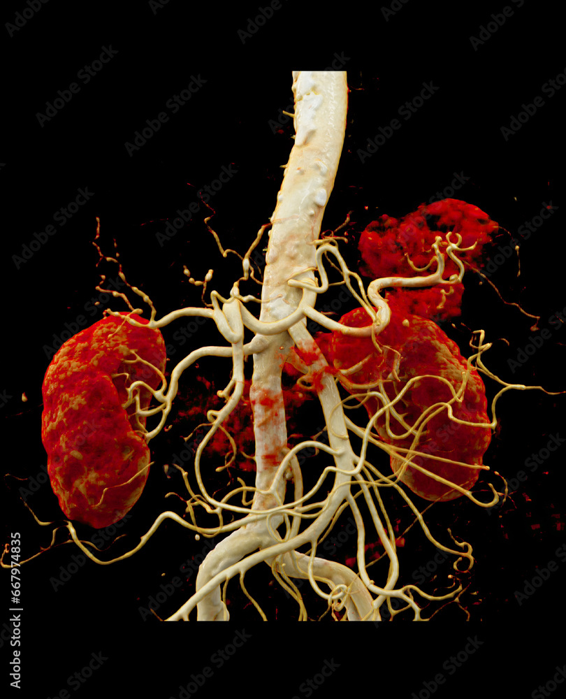 CTA Renal artery is a medical imaging procedure using CT scans to ...