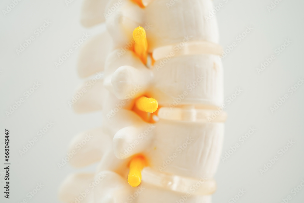 Spinal nerve and bone, Lumbar spine displaced herniated disc fragment ...